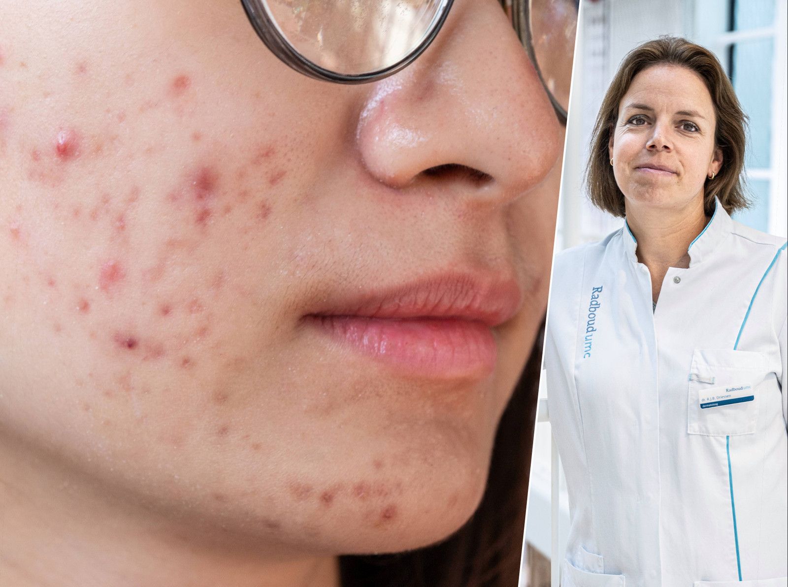 Geen puber meer, toch puistjes: hoe kan dat, en hoe kom je van die vervelende acne af?