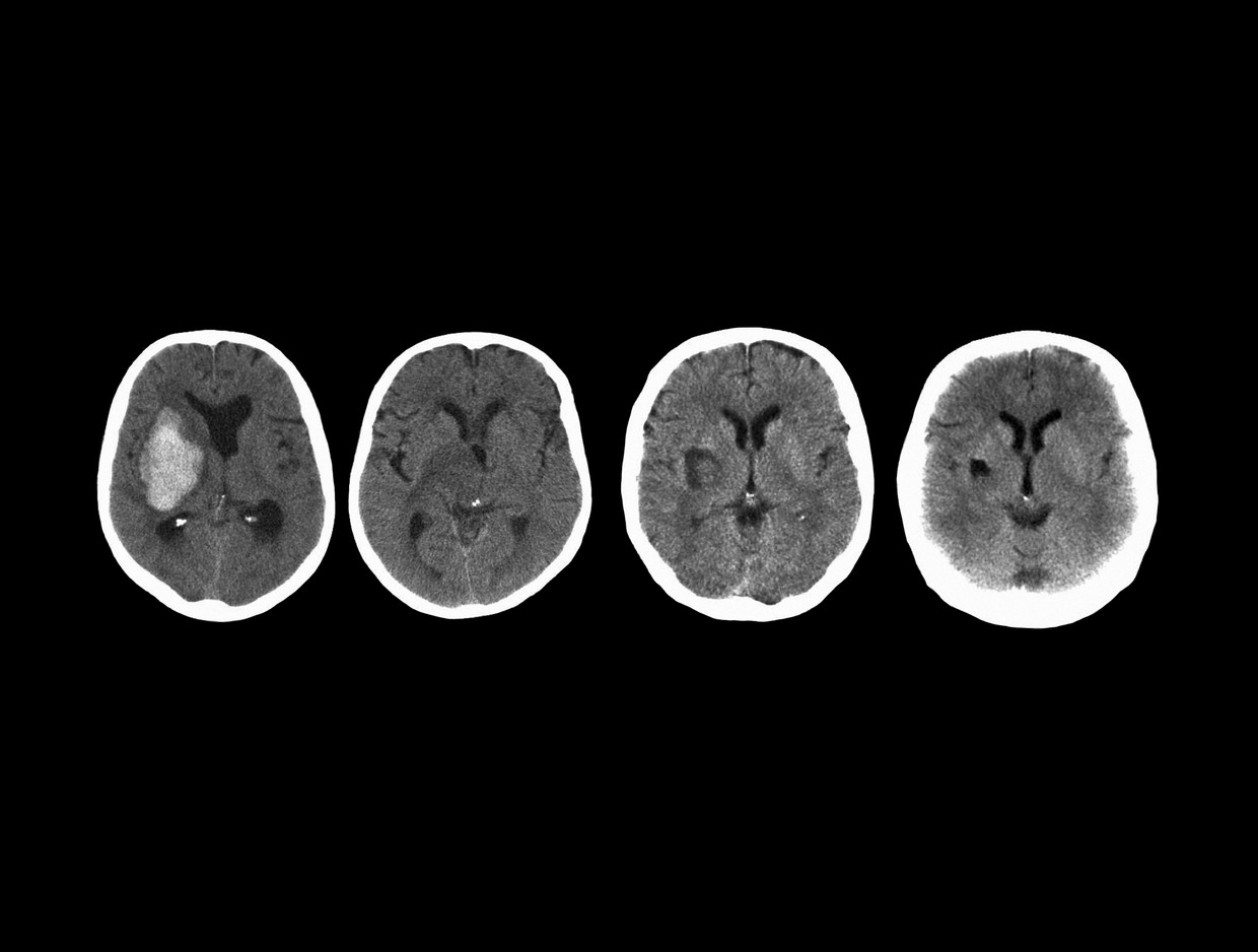 Te laag cholesterolgehalte verdubbelt risico op hersenbloeding