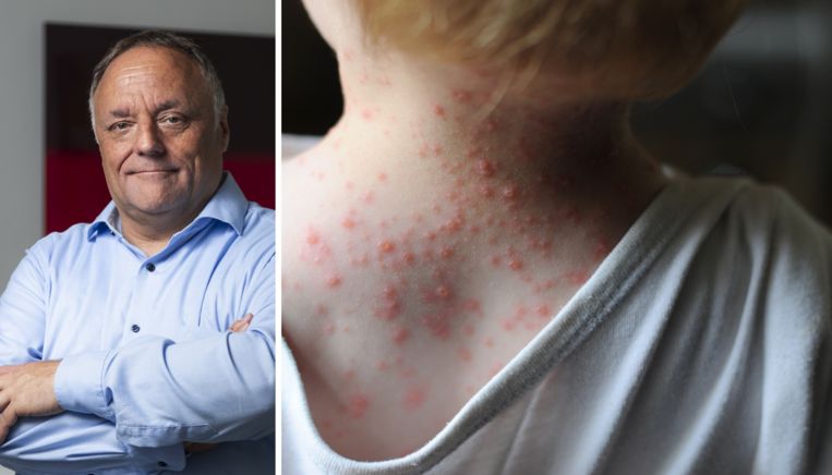 Marc Van Ranst gekant tegen nieuwe regels windpokken: ‘Alsof we niets ...